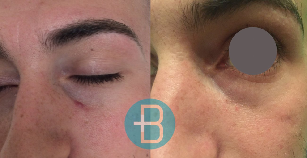 Lesiones Dermatológicas - Medicina Estética Pozuelo de Alarcón ...