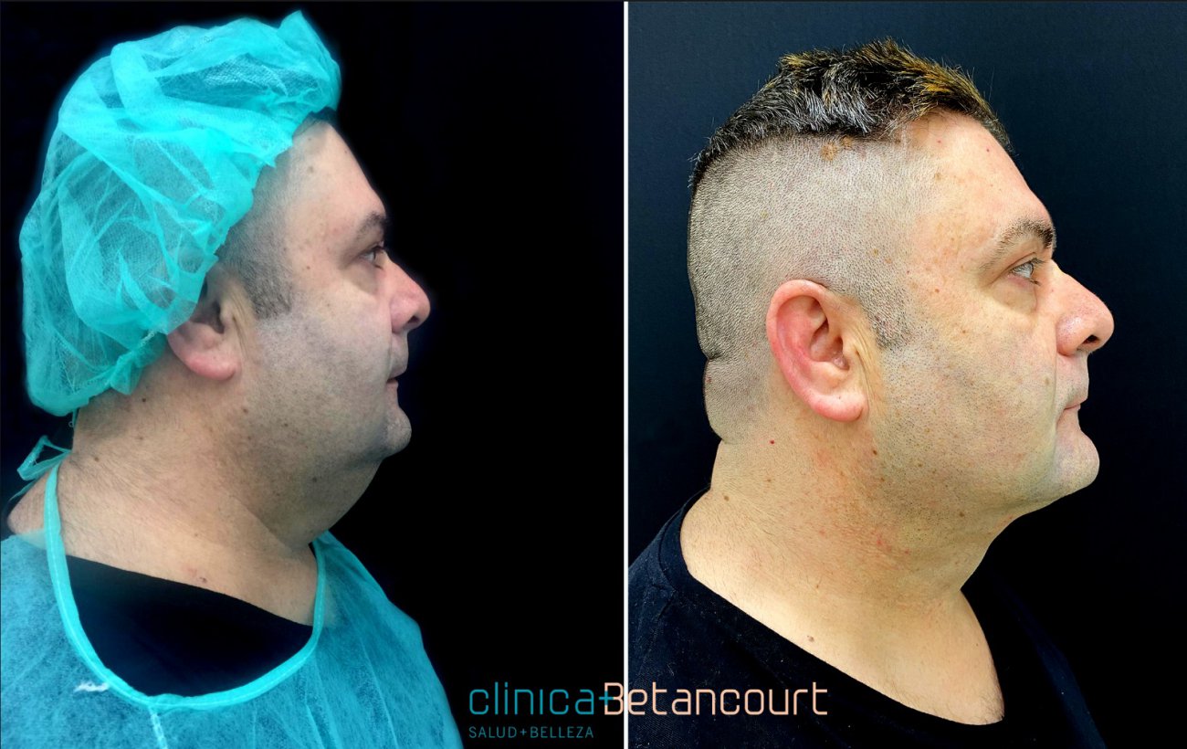 ENDOLIFTING MADRID | CLÍNICA BETANCOURT