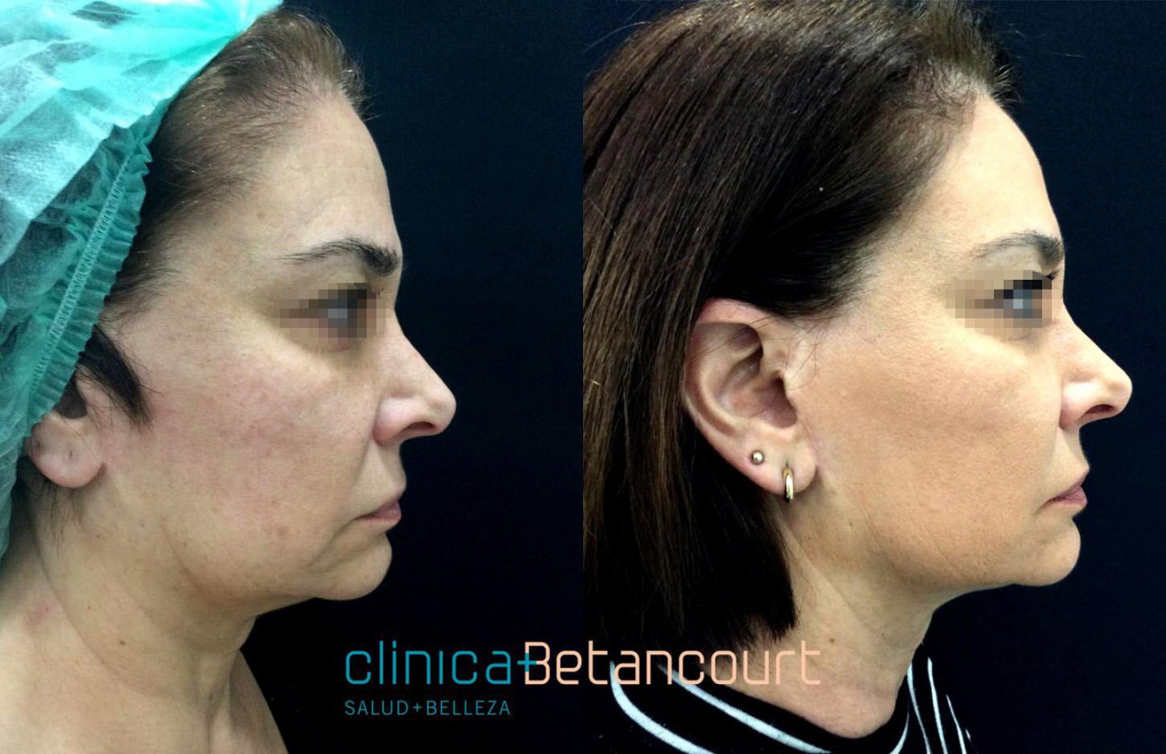 ENDOLIFTING FACIAL | CLÍNICA BETANCOURT | REJUVENECIMIENTO