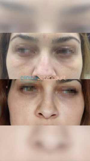 Solución Festón Malar Madrid | CLÍNICA BETANCOURT